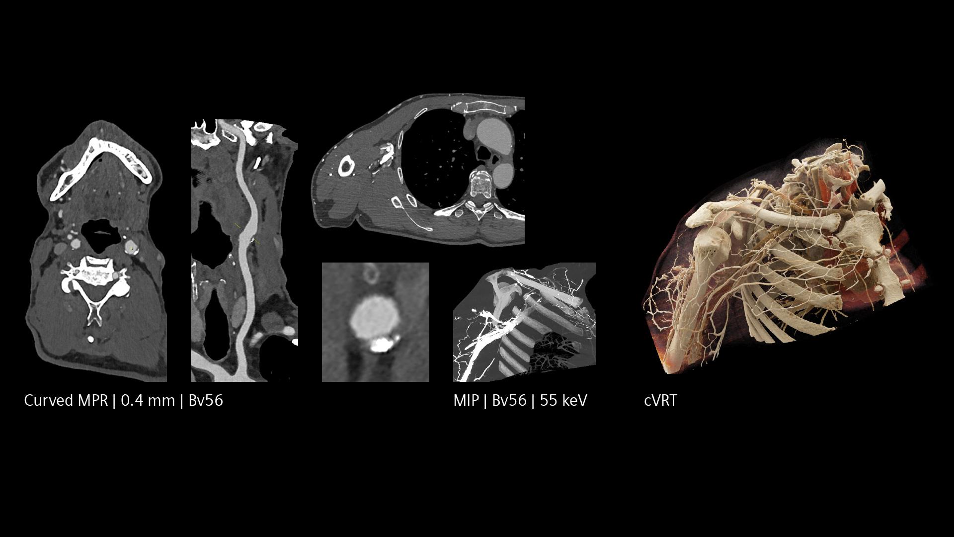 PCCT neurology imaging - Siemens Healthineers