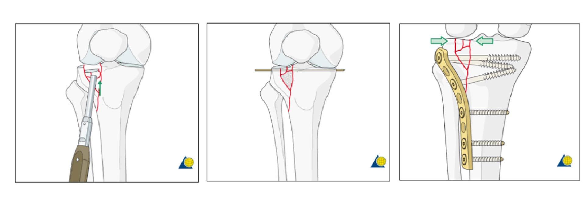 Tibia proximal - Siemens Healthineers Latinoamérica
