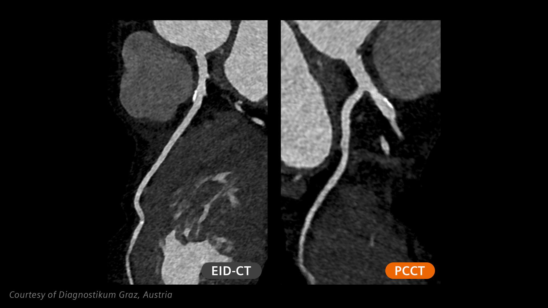 NAEOTOM Alpha.Prime - The first single-source photon-counting CT ...