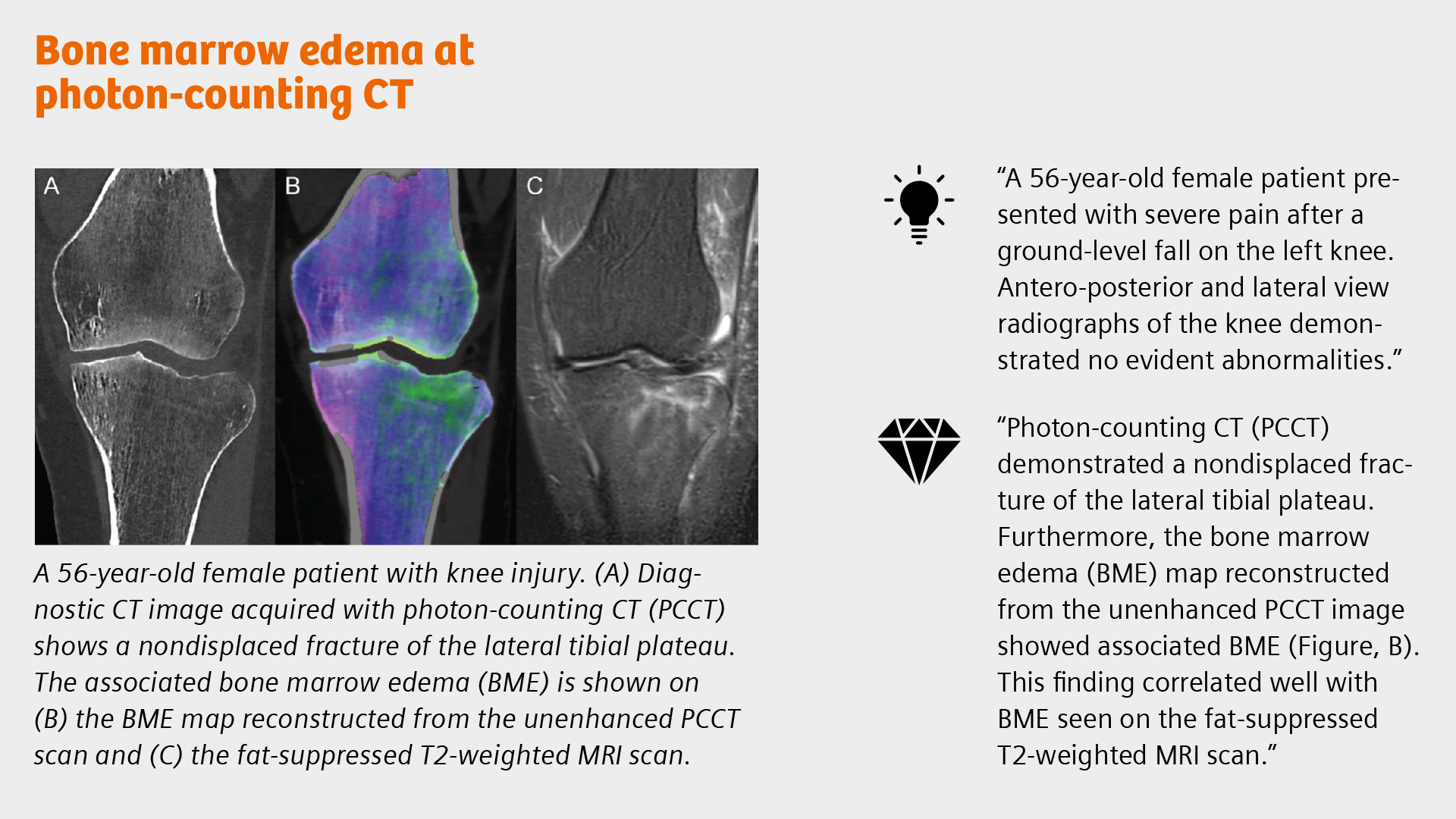 Bone marrow edema at photon-counting CT - Siemens Healthineers