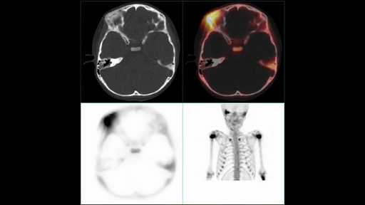 99mTc MDP SPECT/CT imaging in the evaluation of pediatric McCune ...