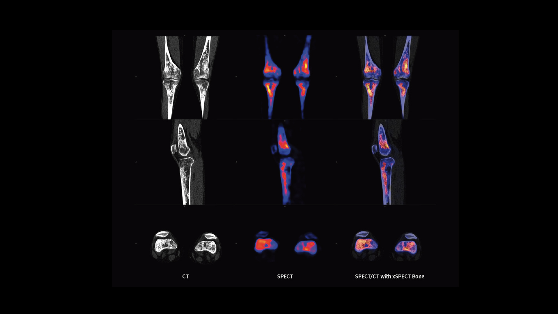 99mTc MDP SPECT/CT Imaging in Diagnosing Erdheim-Chester Disease