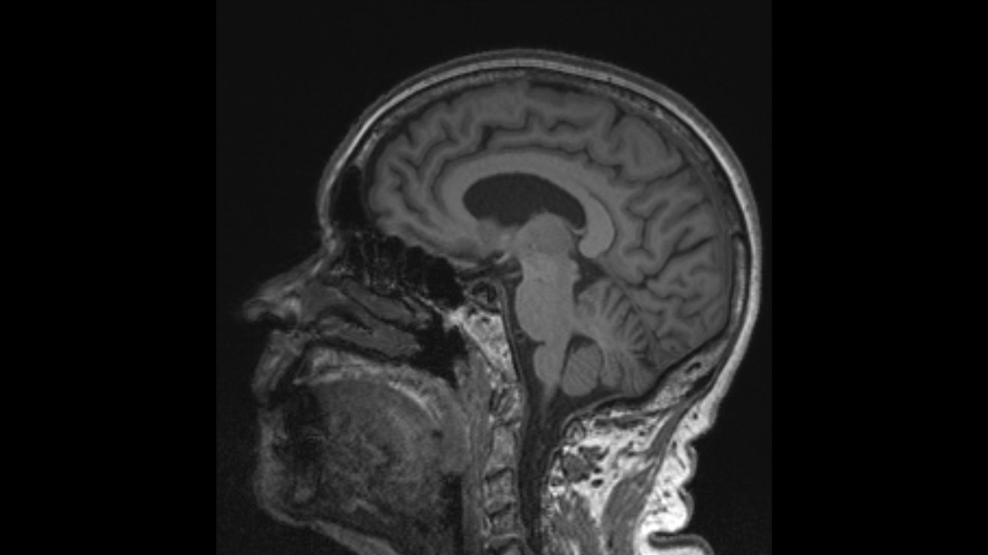 AI-Rad Companion - Siemens Healthineers