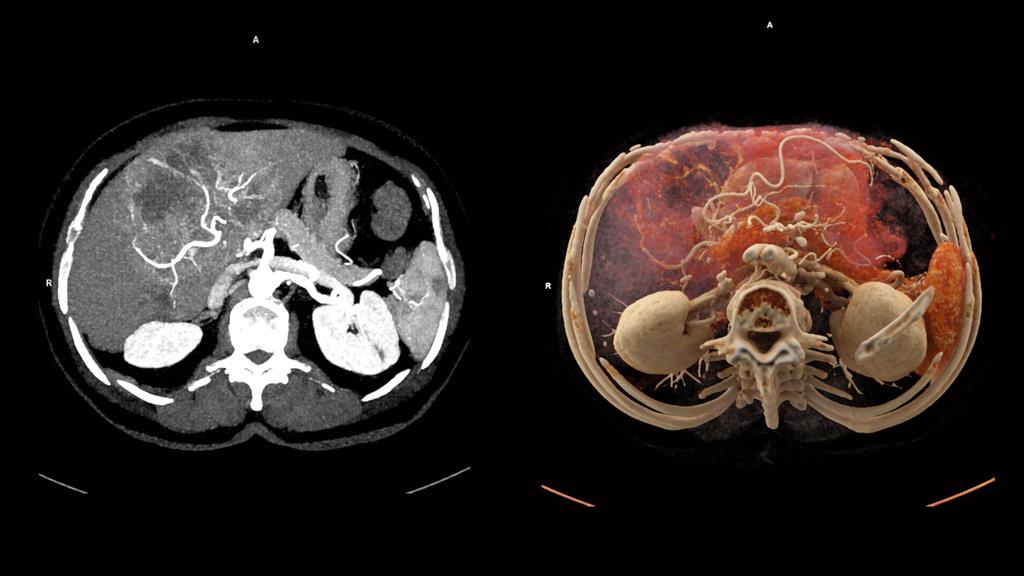 Liver Cancer Management - Siemens Healthineers