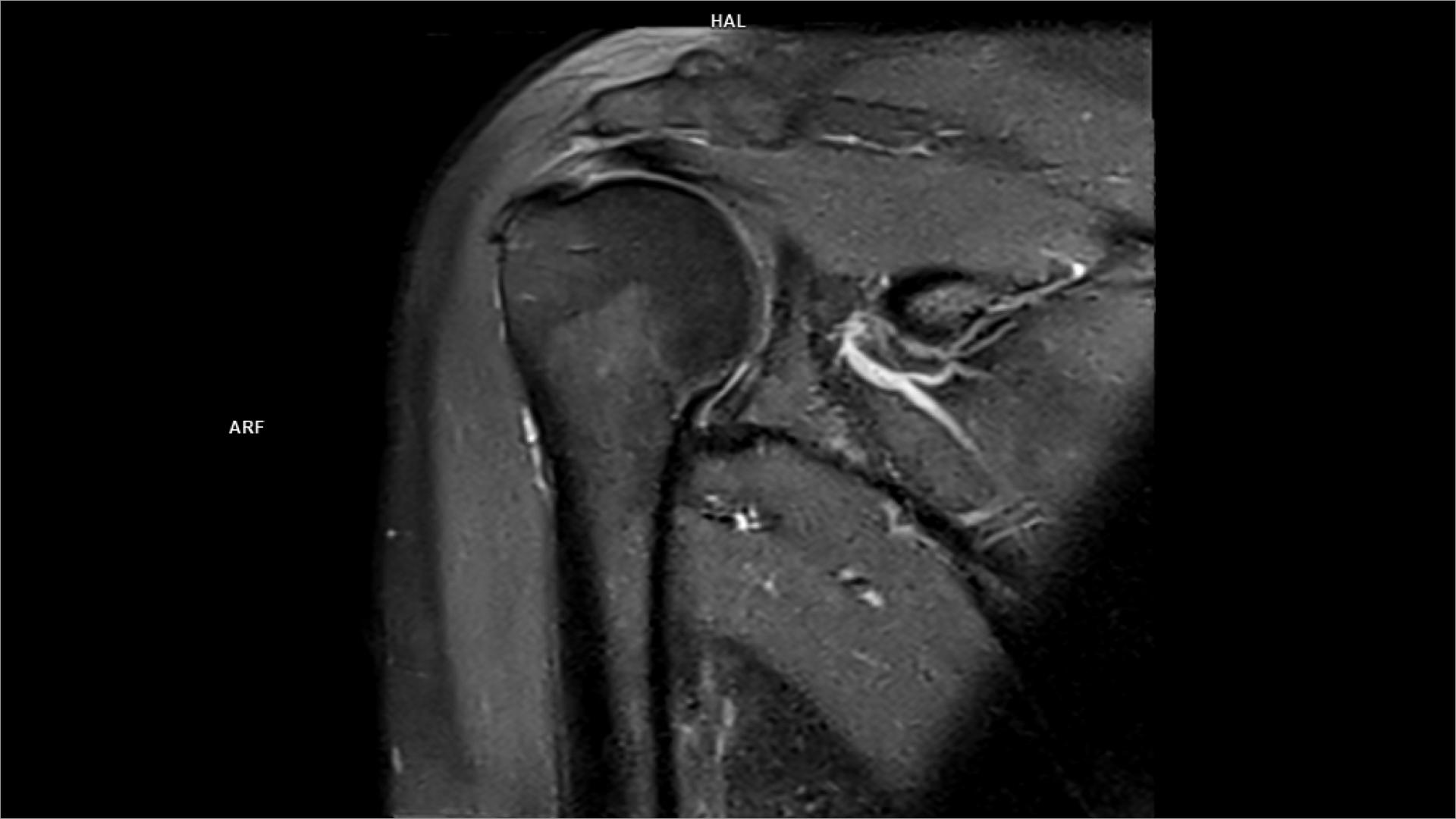 Coronal PD FS-MAGNETOM Free.Max - Siemens Healthineers USA