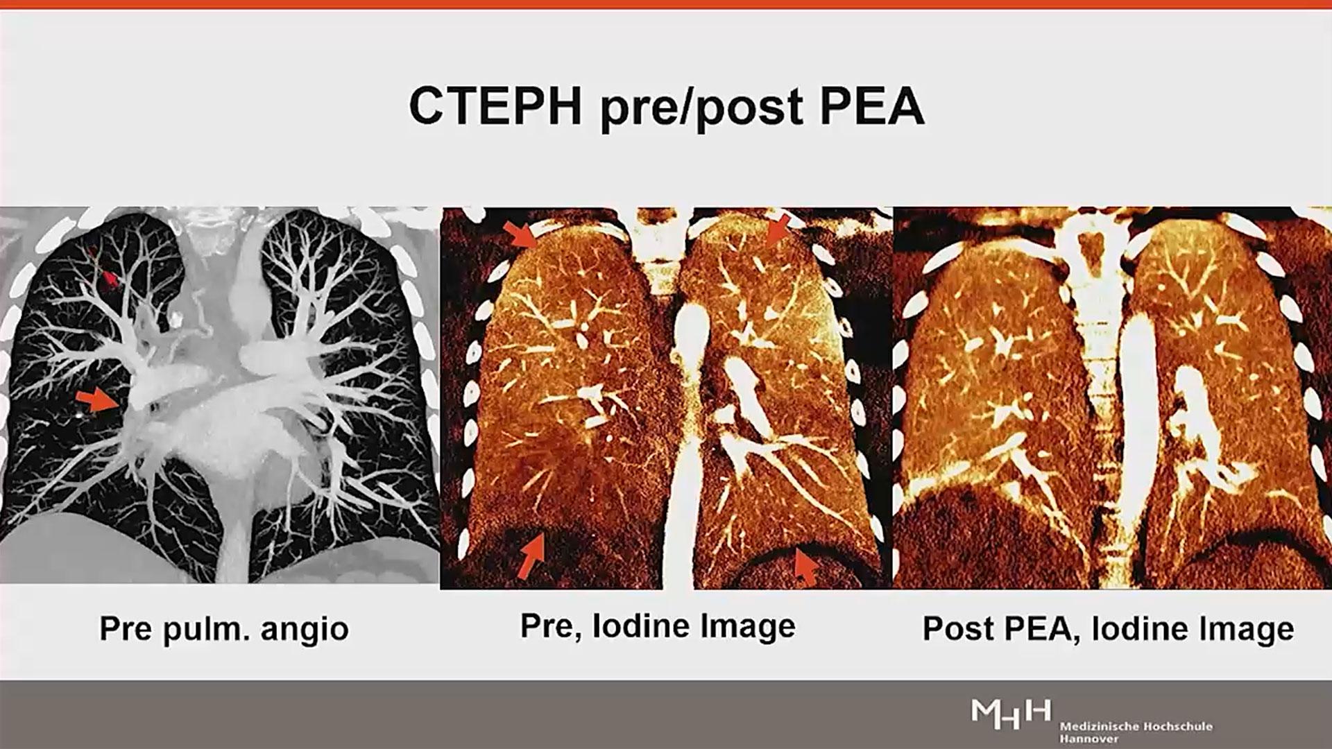 Photon counting CT and its added value in thoracic imaging - Siemens ...
