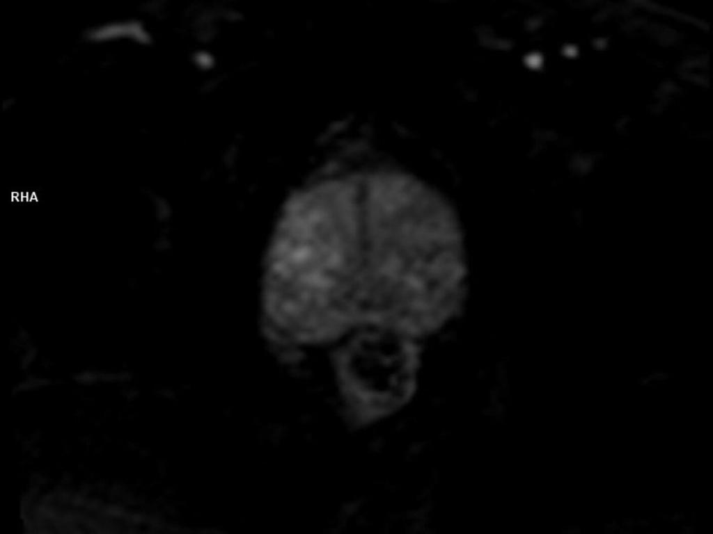 AXIAL RESOLVE DWI _ b1000-MAGNETOM Vida - Siemens Healthineers USA