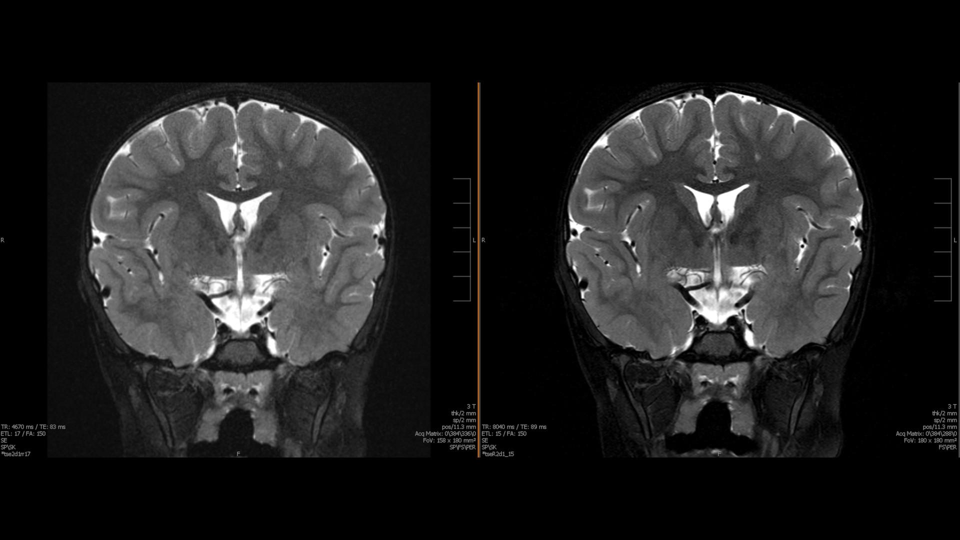 Pediatric protocols using Deep Resolve