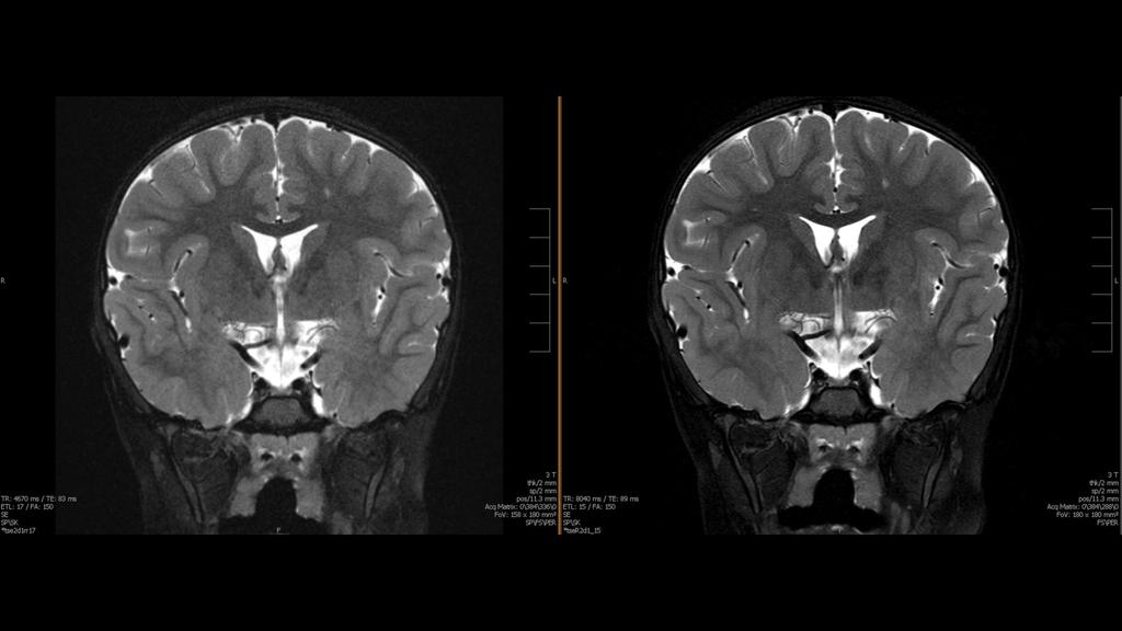 Pediatric protocols using Deep Resolve