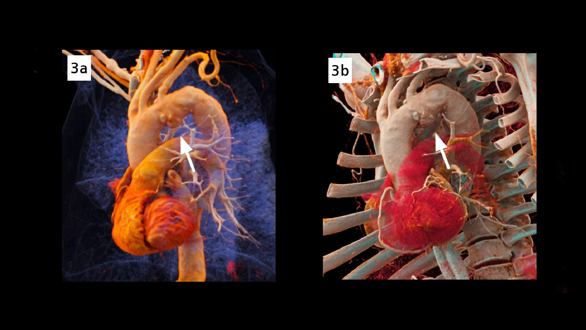 Complex Thoracoabdominal Aortic Aneurysm – EVAR with Renovisceral ...