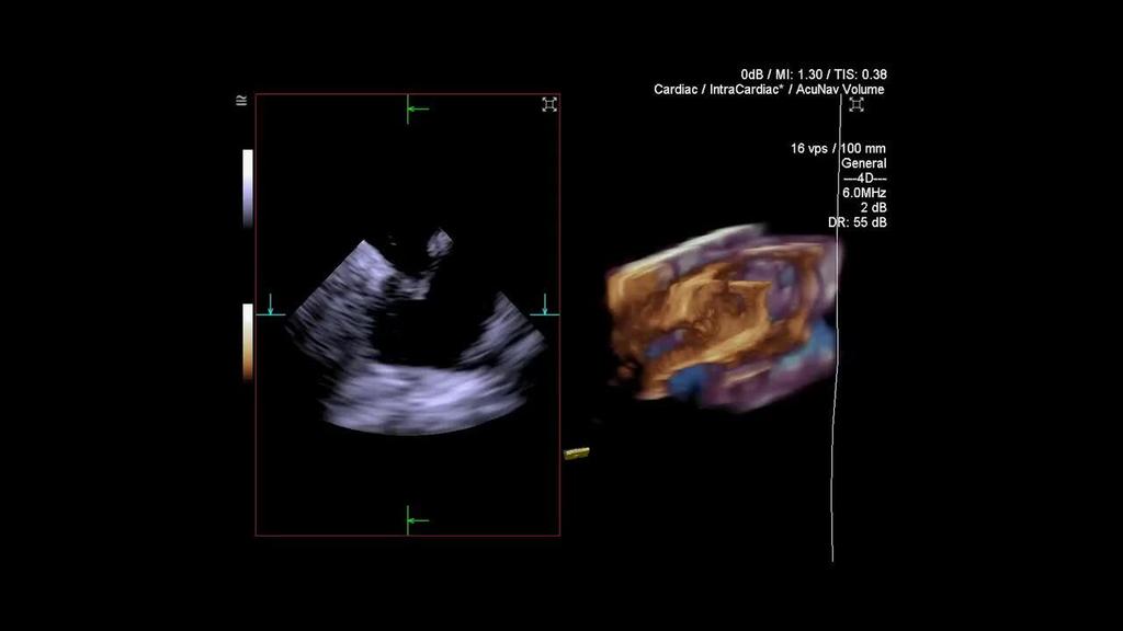 Intracardiac Echocardiography with AcuNav Ultrasound Catheters