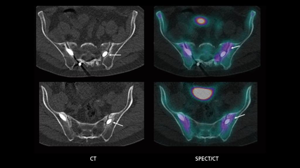 SPECT/CT imaging in the evaluation of pain following spinal fusion ...