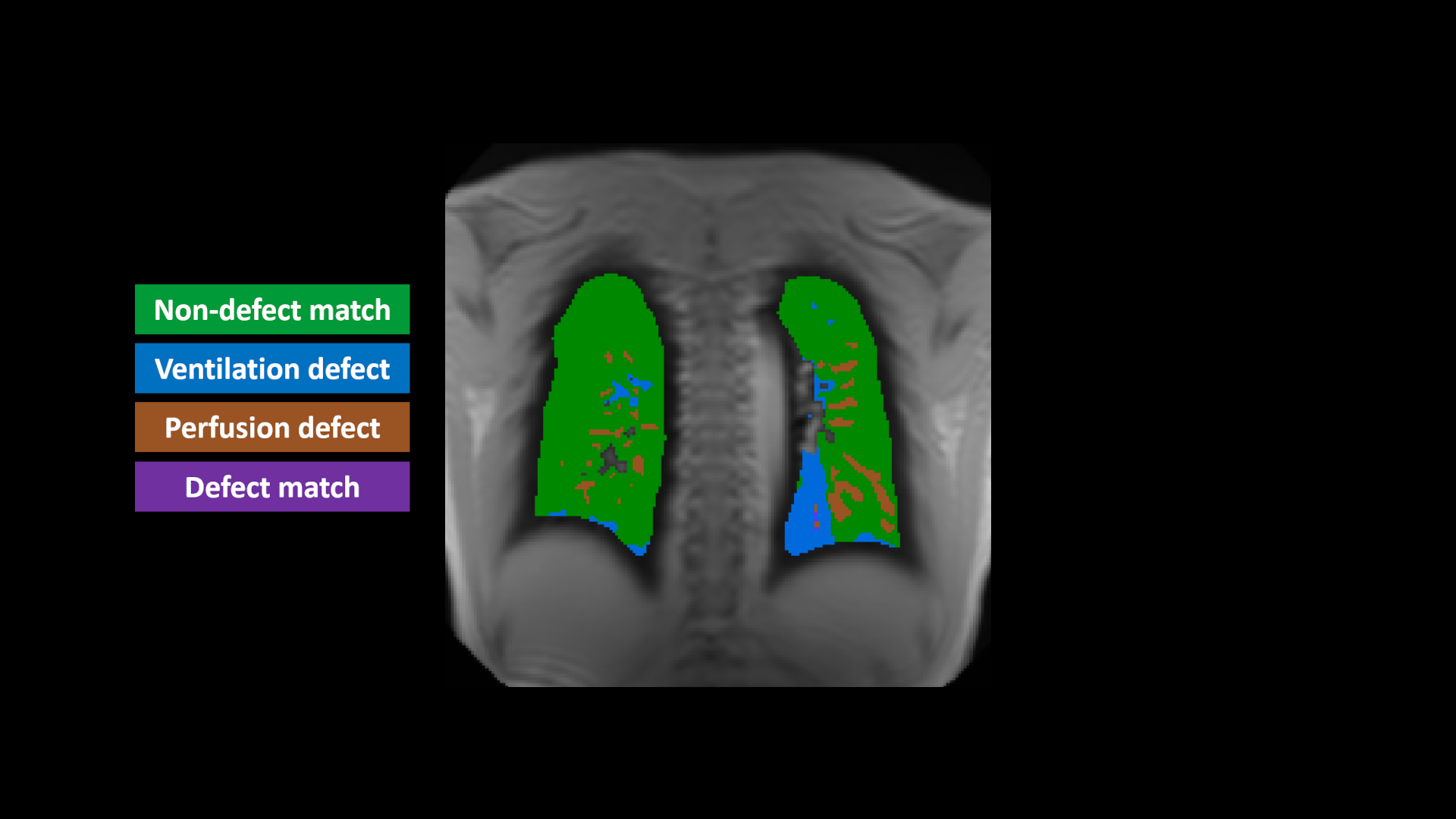 Pulmonary MRI - Siemens Healthineers