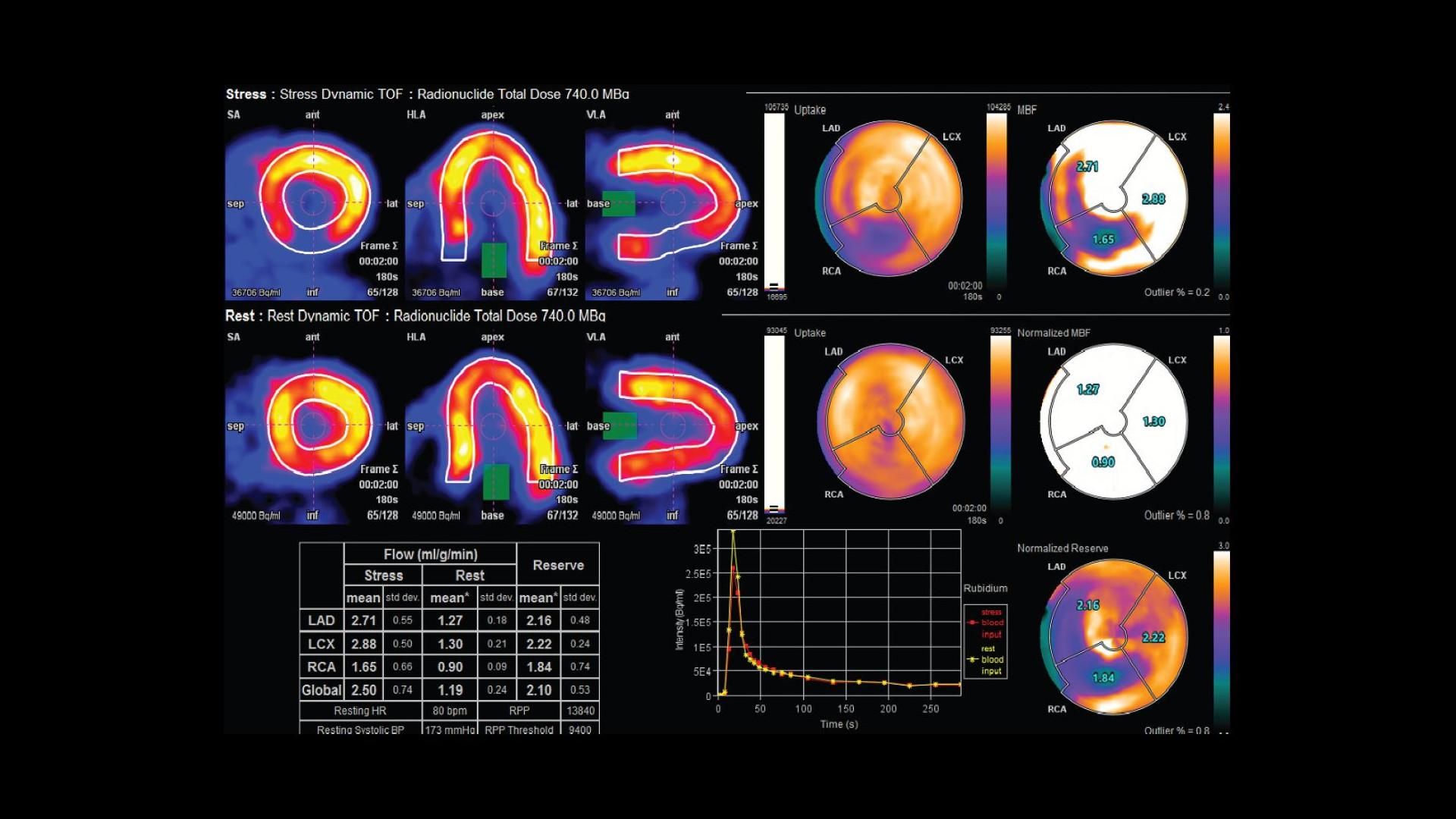 PET/CT delineation of multivessel coronary artery disease and post ...