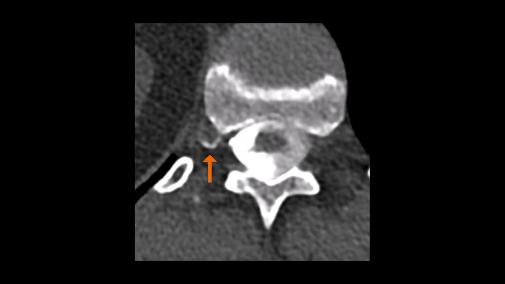 PCCT neurology imaging - Siemens Healthineers