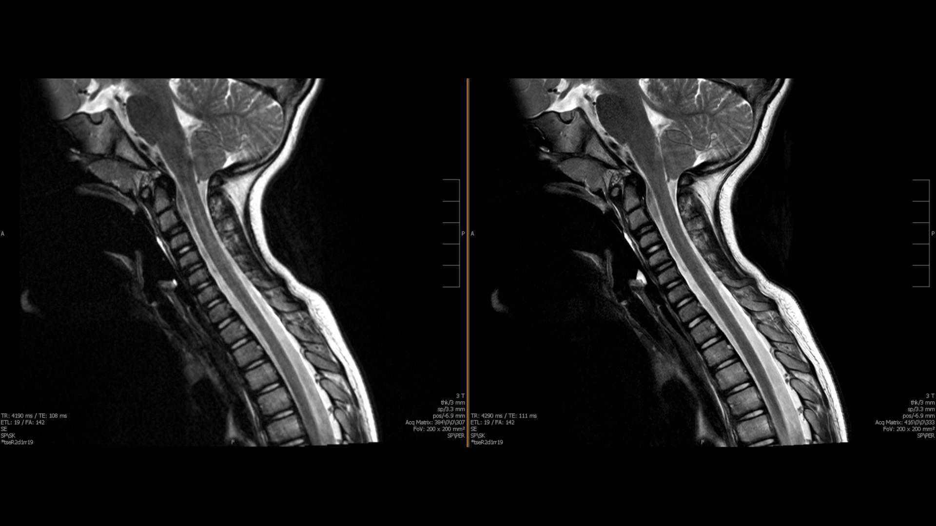 Pediatric protocols using Deep Resolve