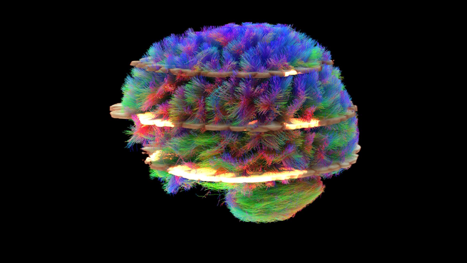 Neurology MRI - Siemens Healthineers