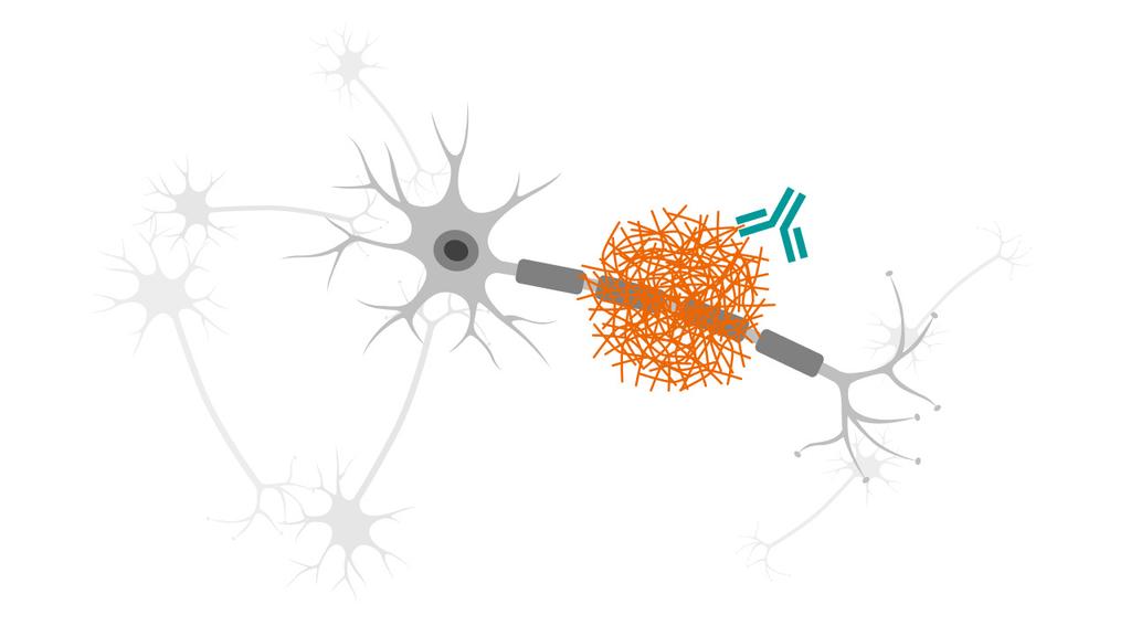 MRI for Alzheimer's disease - Siemens Healthineers USA