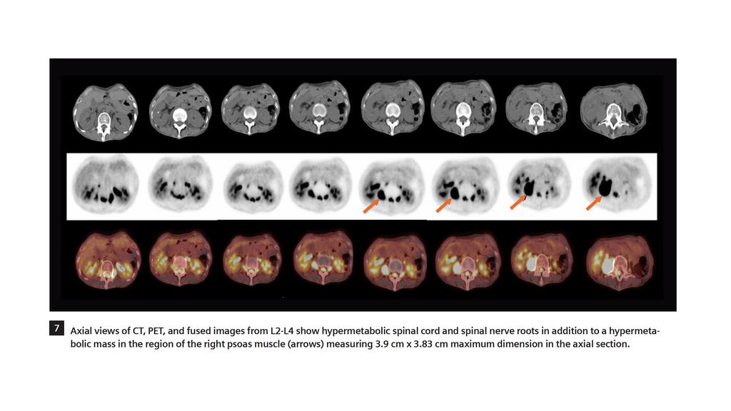 18F FDG PET/CT Delineation of Diffuse Large B-cell Lymphoma - Siemens Healthineers USA