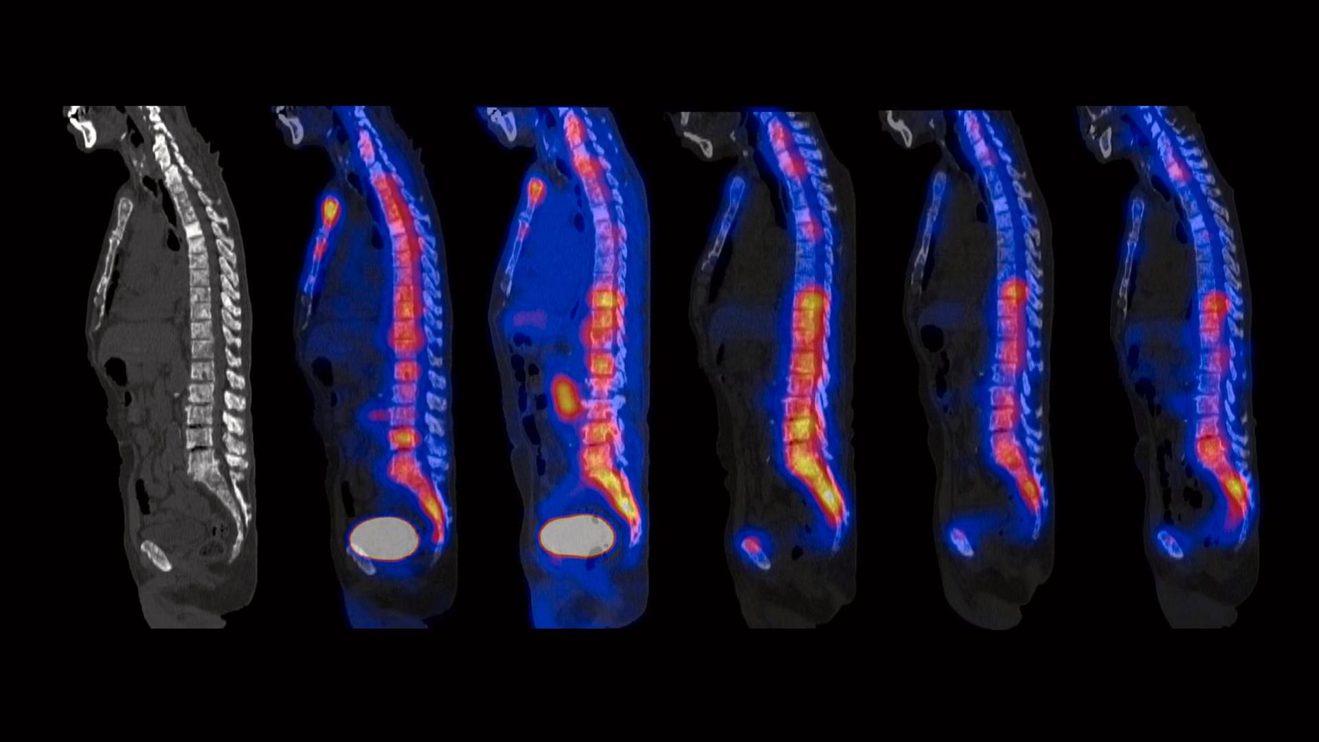 Fast Quantitative Spectct Acquisition Following Multiple Therapy Cycles Of 177lu Psma 617