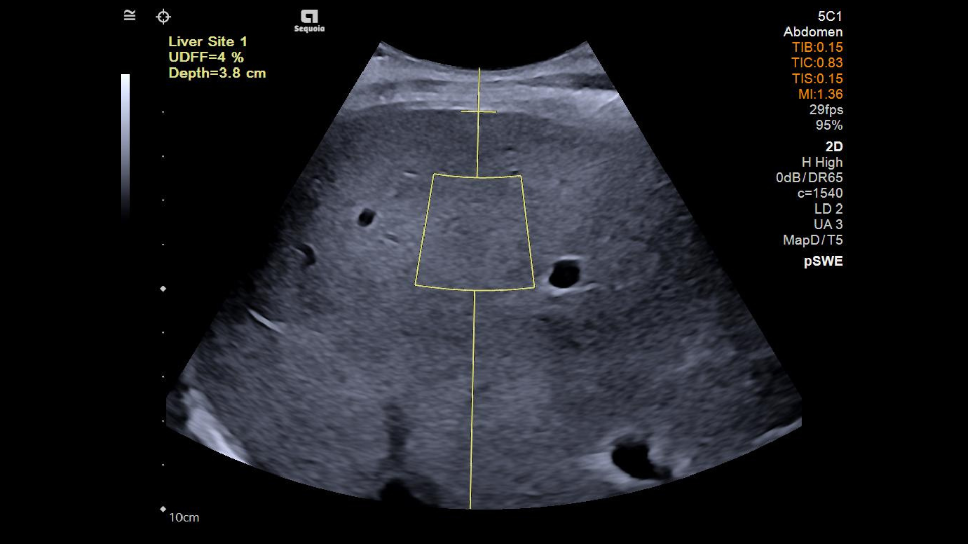 Ultrasound-derived fat fraction (UDFF) shows high accuracy in detecting hepatic steatosis ...