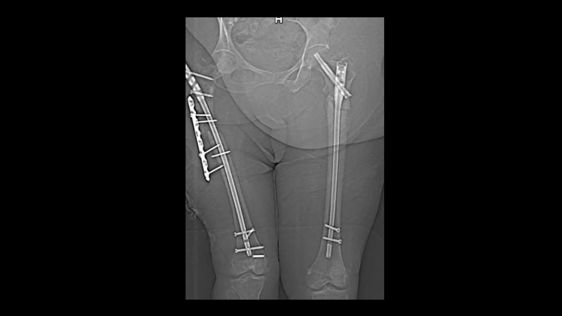 Localization Of Infection Site In Femoral Stabilization Pin - Siemens ...
