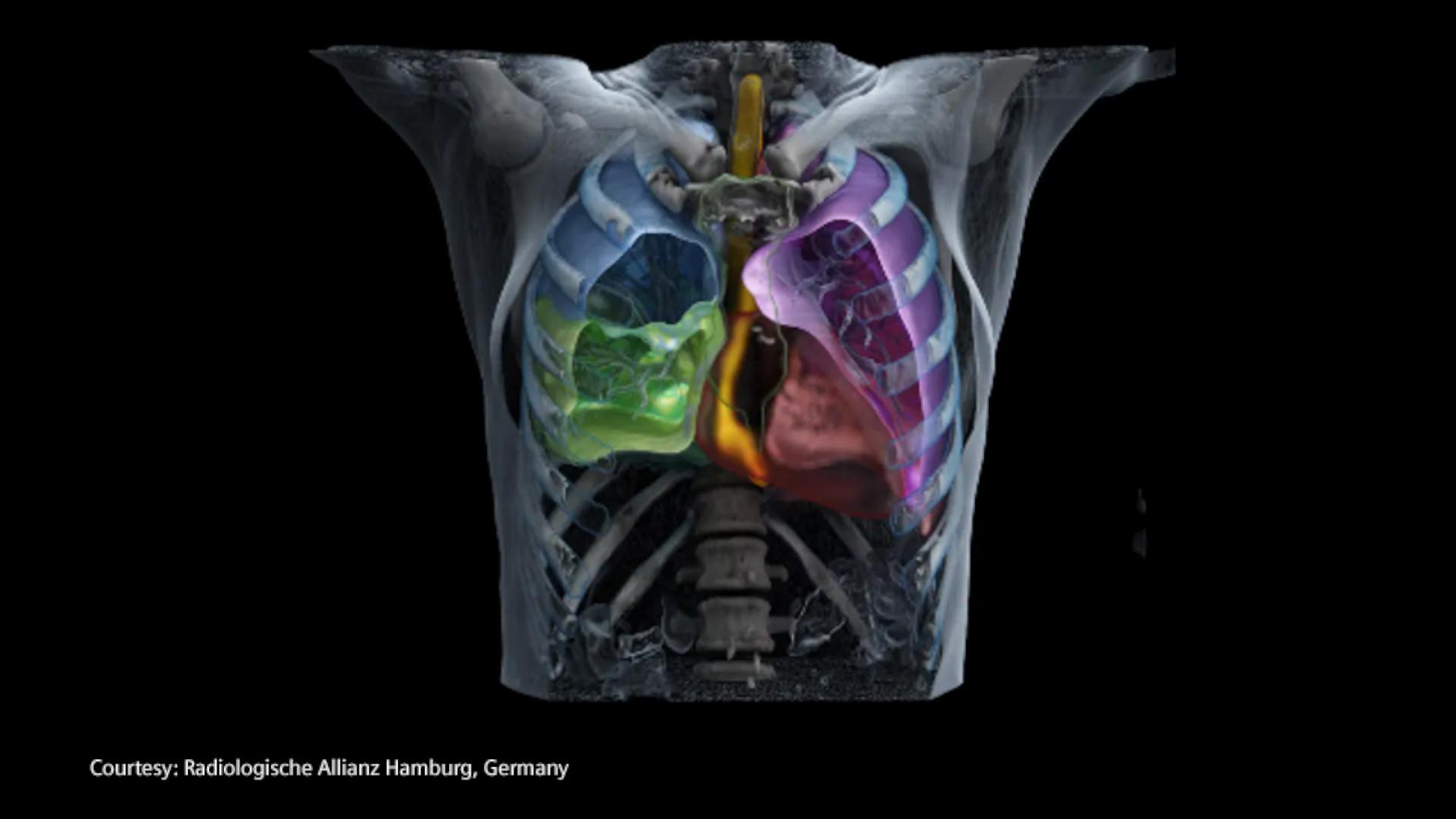 Diagnosis And Treatment Of Lung Cancer - Siemens Healthineers