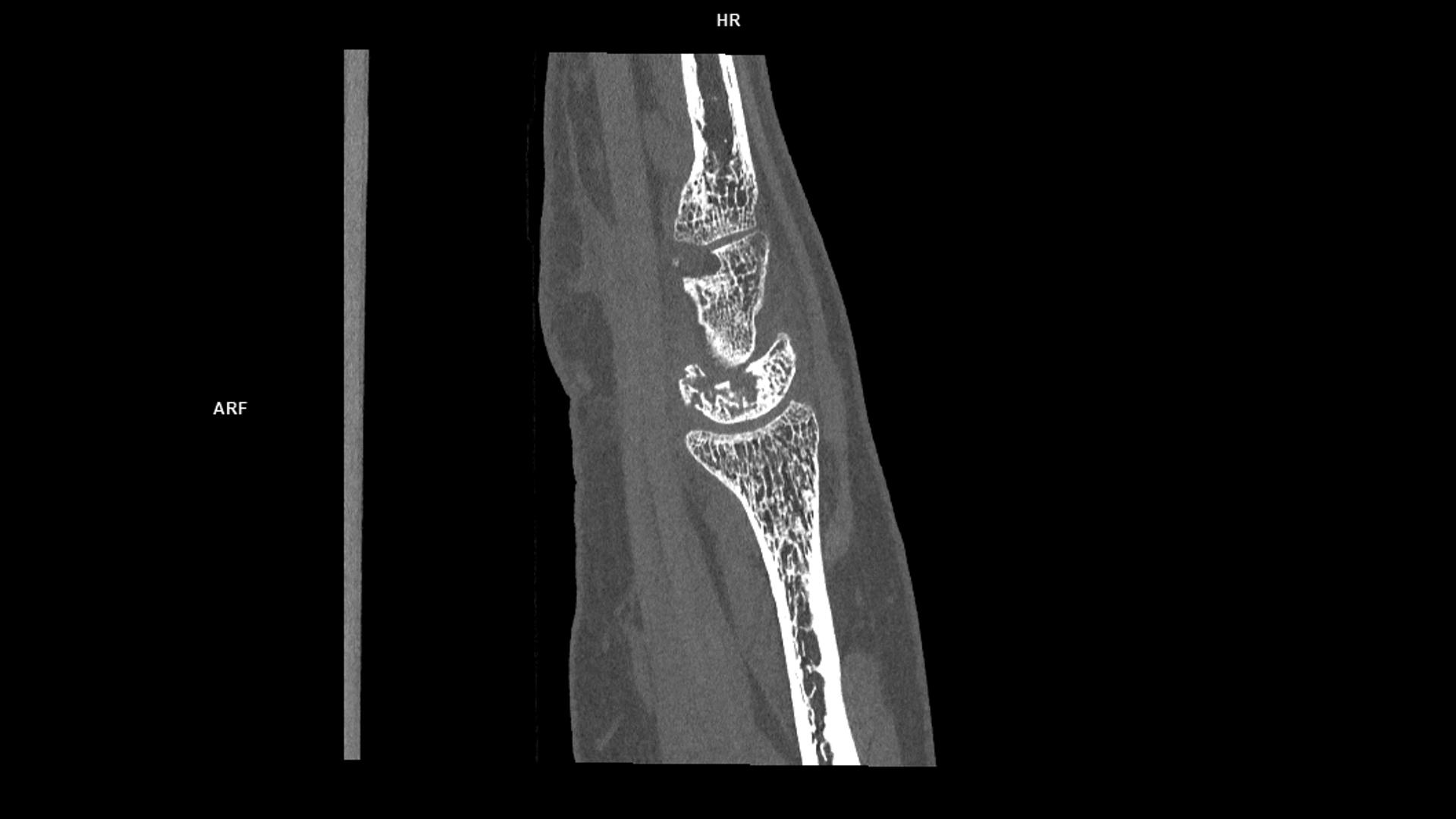 NAEOTOM Alpha photon-counting CT scanner - Siemens Healthineers Singapore