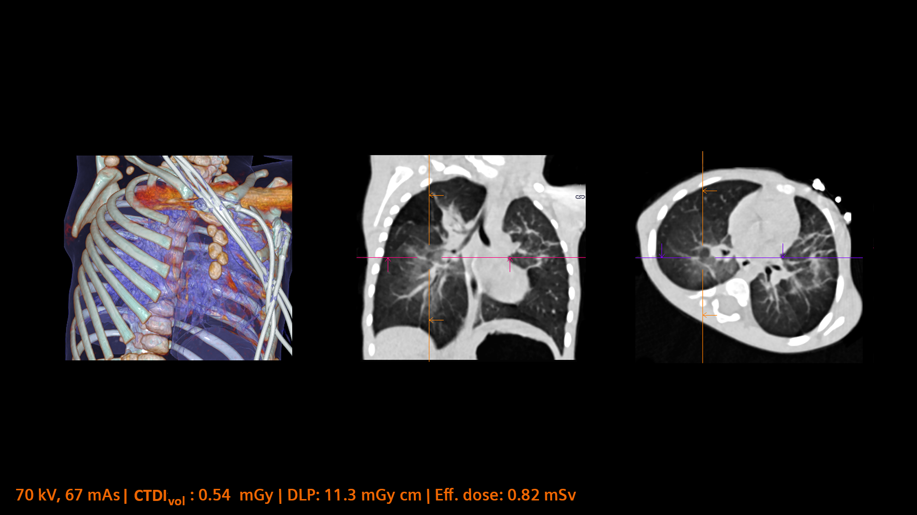 Dual Source CT - Siemens Healthineers