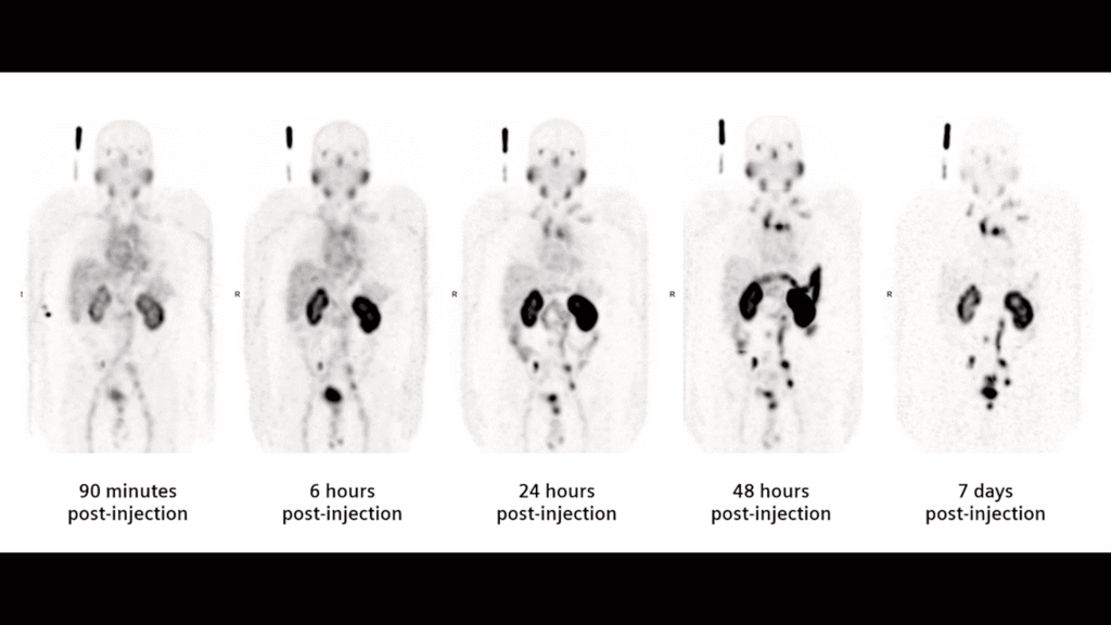 Tumor & Organ Dosimetry From Sequential Quantitative SPECT/CT - Siemens Healthineers USA