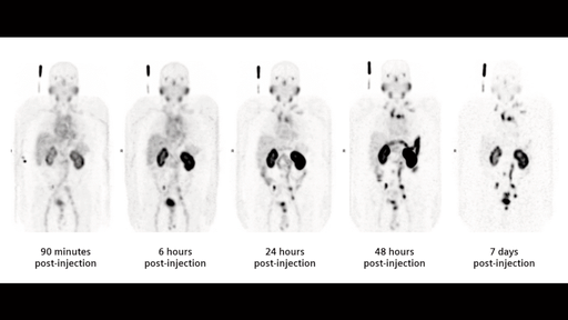 Tumor and organ dosimetry from sequential quantitative SPECT/CT - Siemens Healthineers