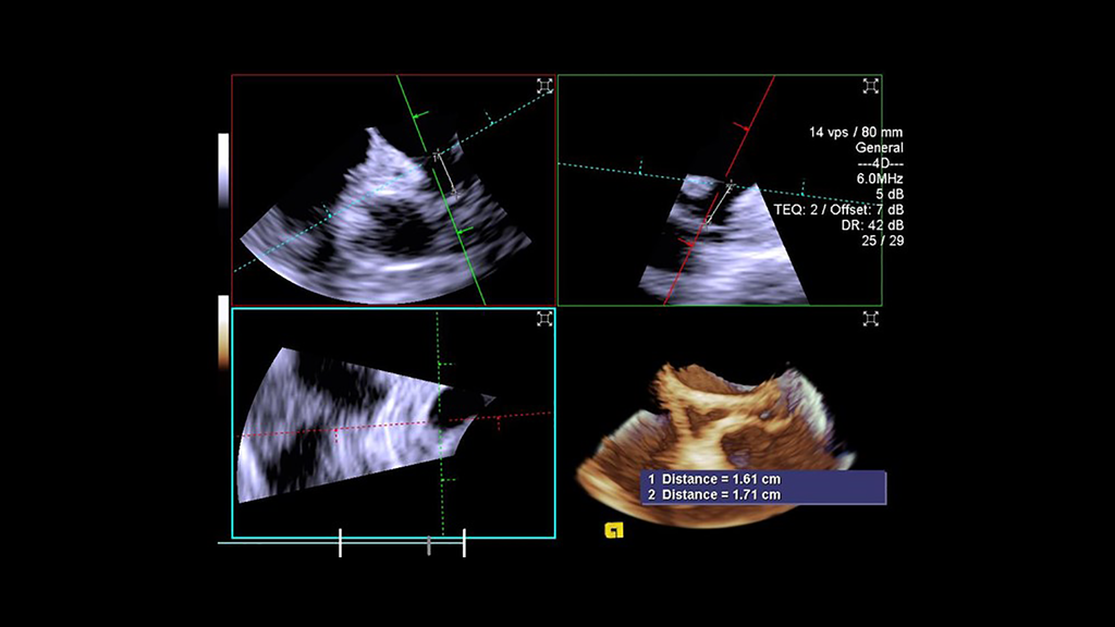 ACUSON AcuNav Volume ICE Catheter - Siemens Healthineers USA