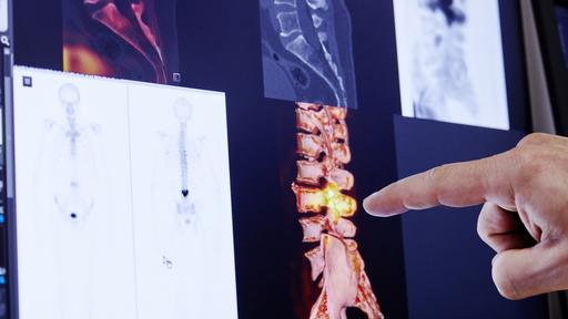 SPECT/CT Provides One-Stop Imaging - Siemens Healthineers