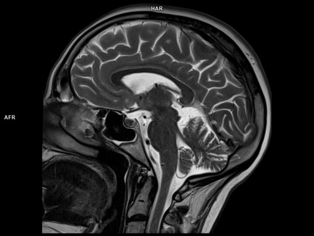 T2 TSE Sag-MAGNETOM Sola - Siemens Healthineers USA