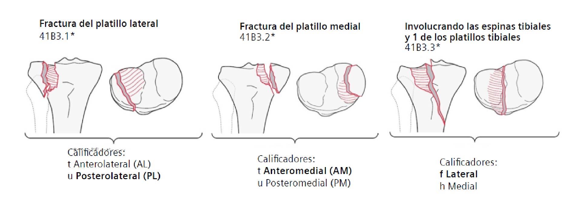 Tibia proximal - Siemens Healthineers Latinoamérica