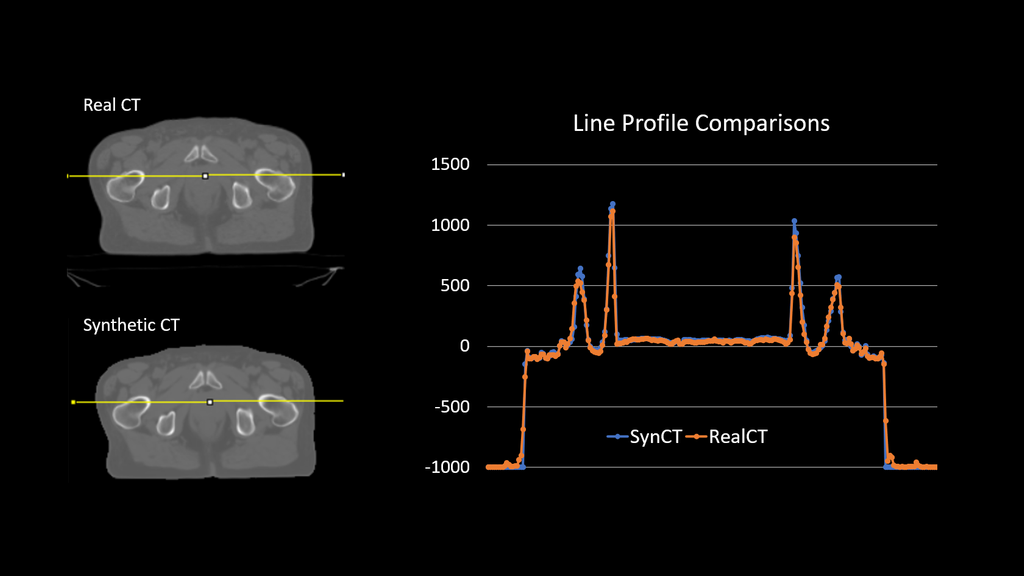 MR-only Radiotherapy Planning