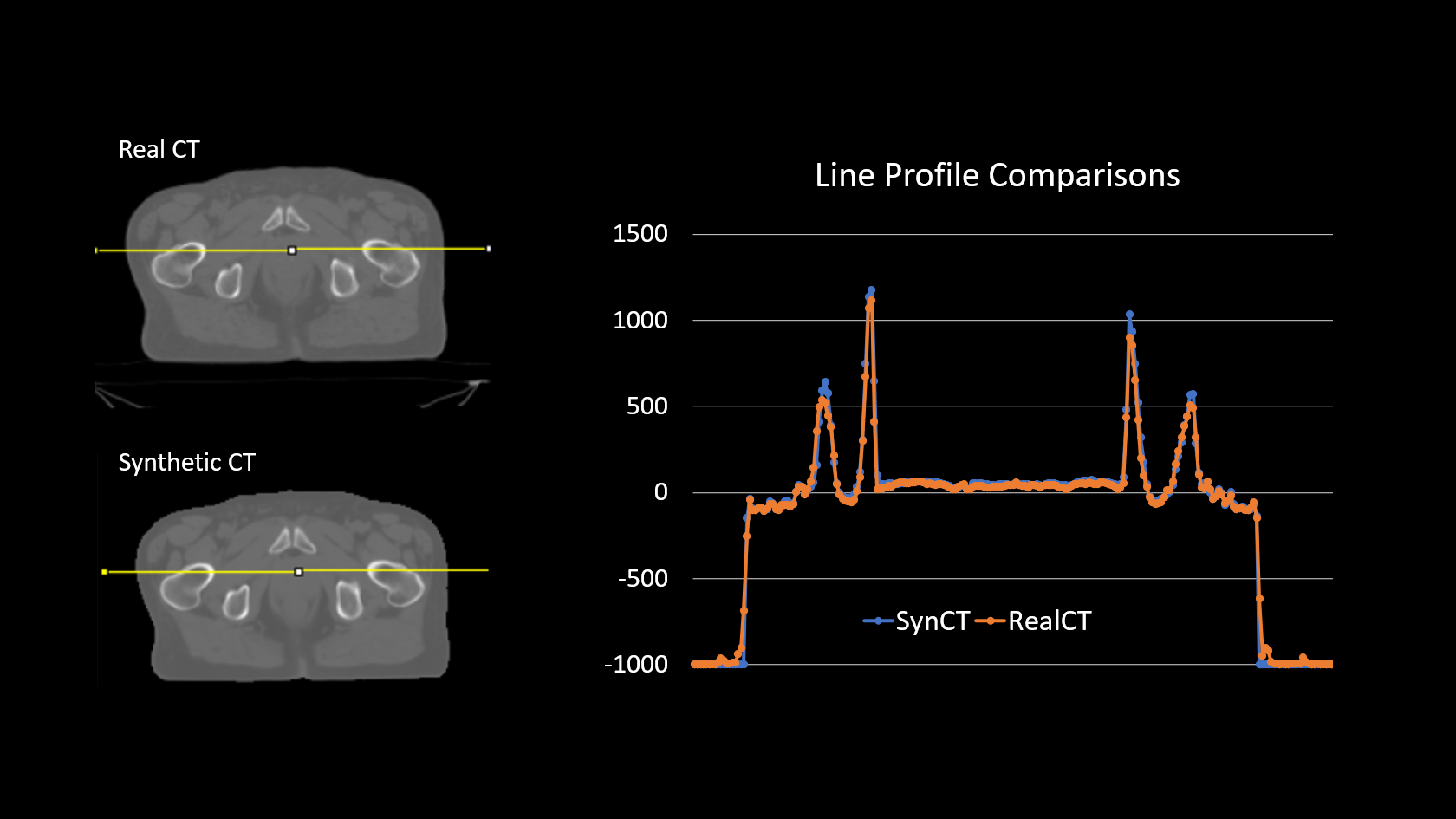 MR-only Radiotherapy Planning