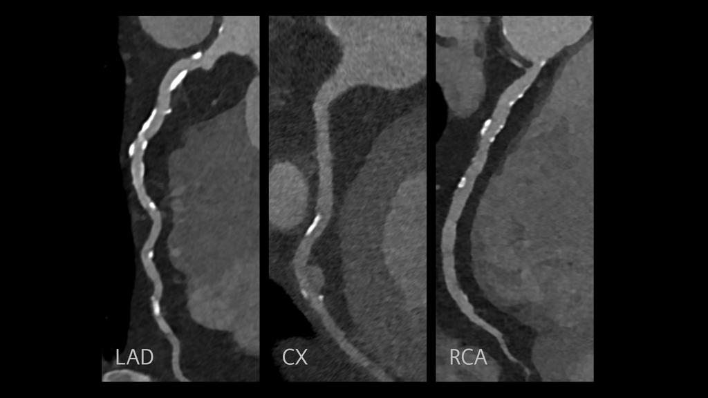 PCCT cardiovascular imaging - Siemens Healthineers