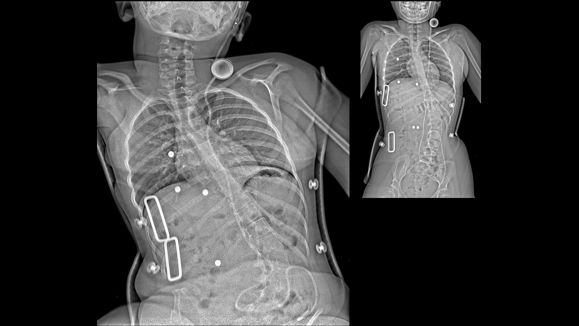 Twin Robotic X-ray scanner – Multitom Rax - Siemens Healthineers