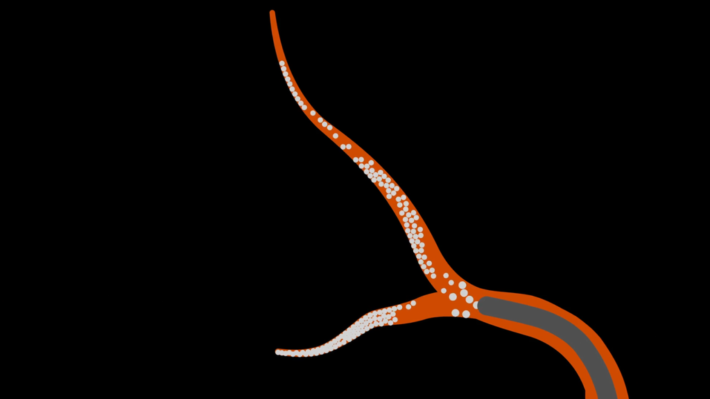 Interventional Oncology Procedures - Siemens Healthineers
