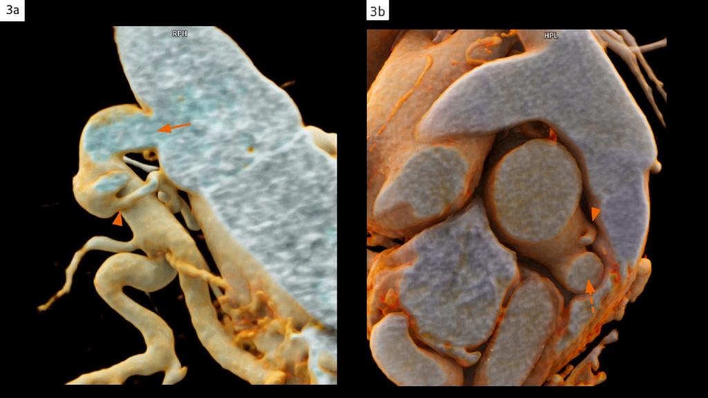 Bland-White-Garland Syndrome in an Adult - Siemens Healthineers USA