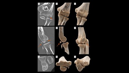 Osteochondritis dissecans of the capitellum - Siemens Healthineers