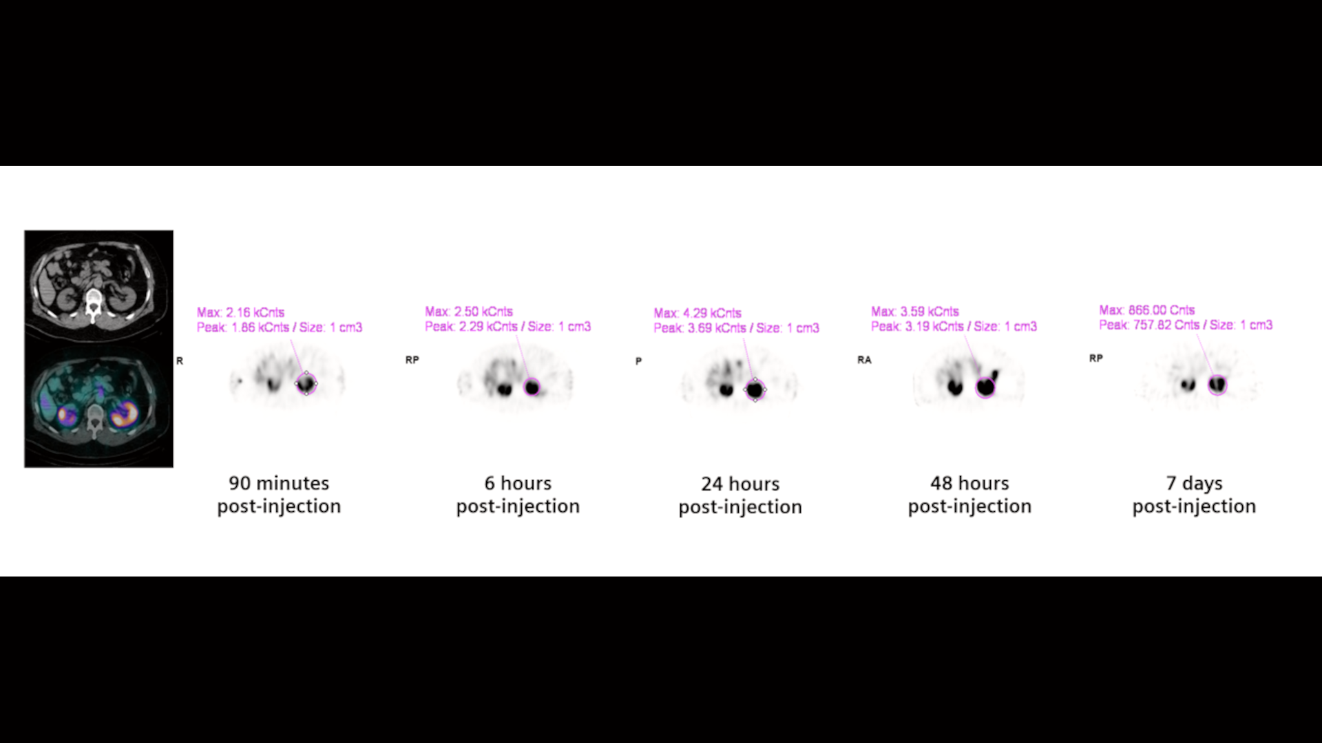 Tumor and organ dosimetry from sequential quantitative SPECT/CT ...