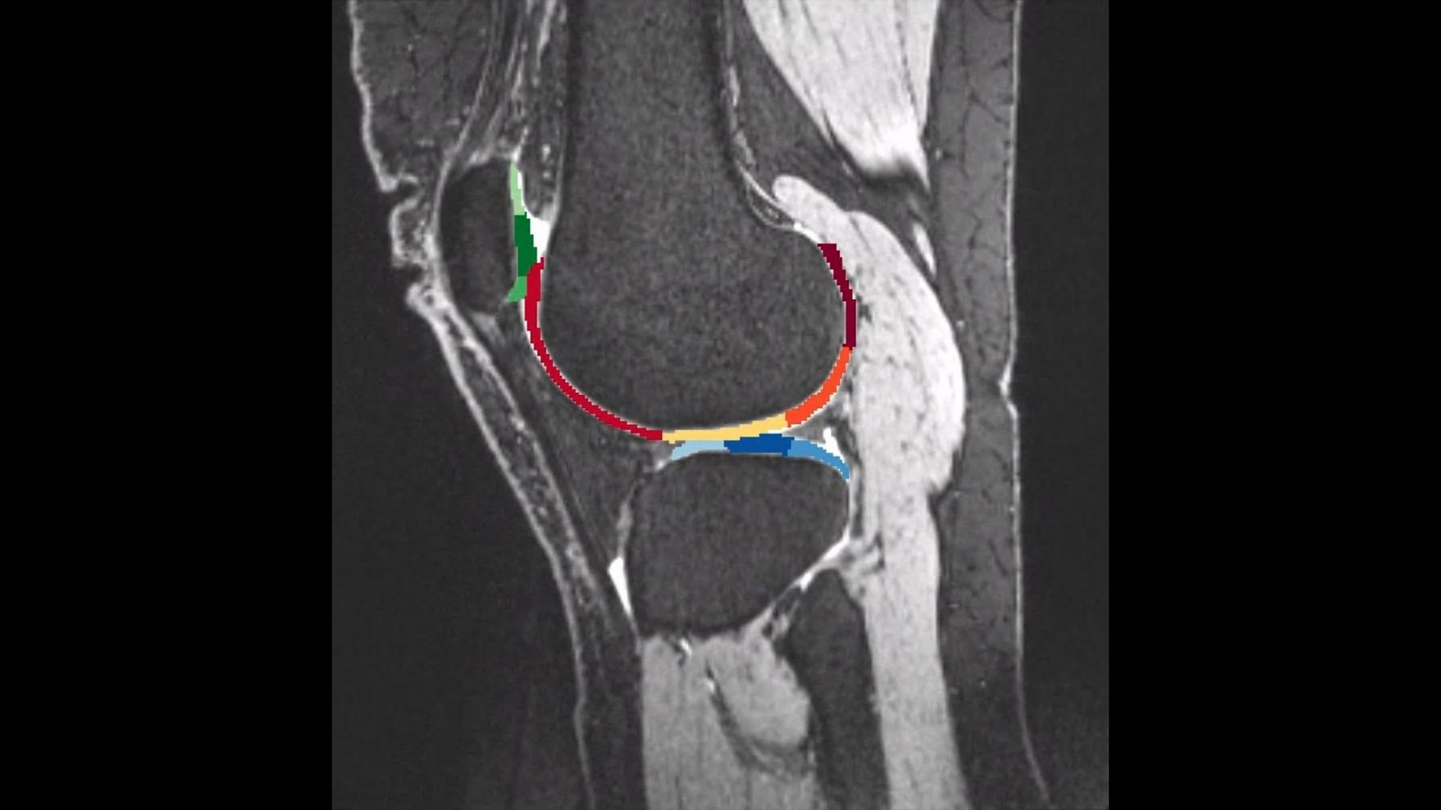MR imaging in sports medicine - Siemens Healthineers