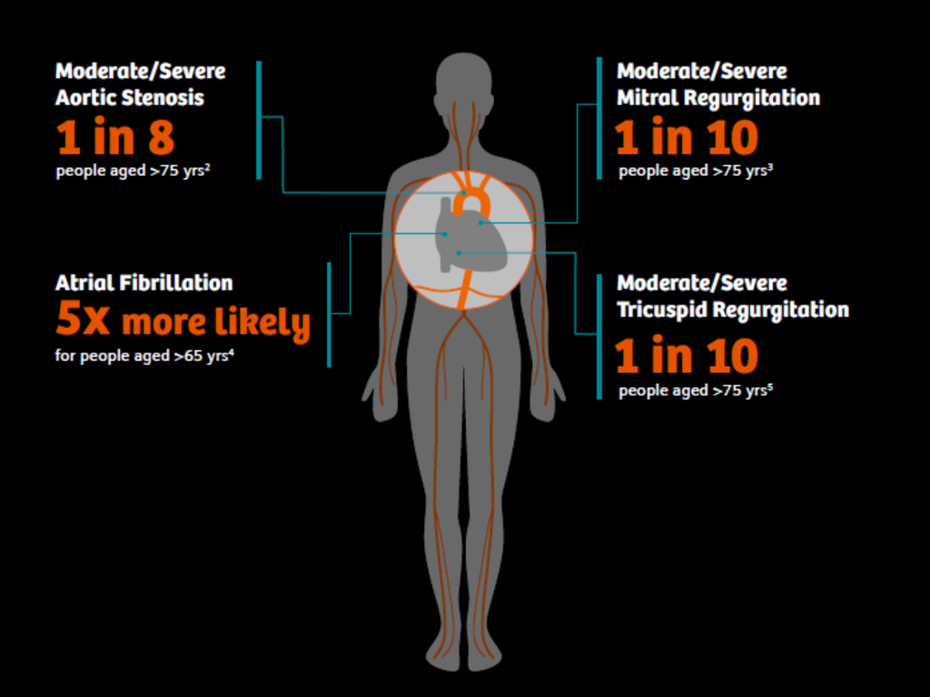 ACUSON AcuNav Volume 4D ICE Catheter - Siemens Healthineers USA