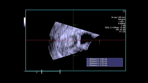 LAAC - Siemens Healthineers USA