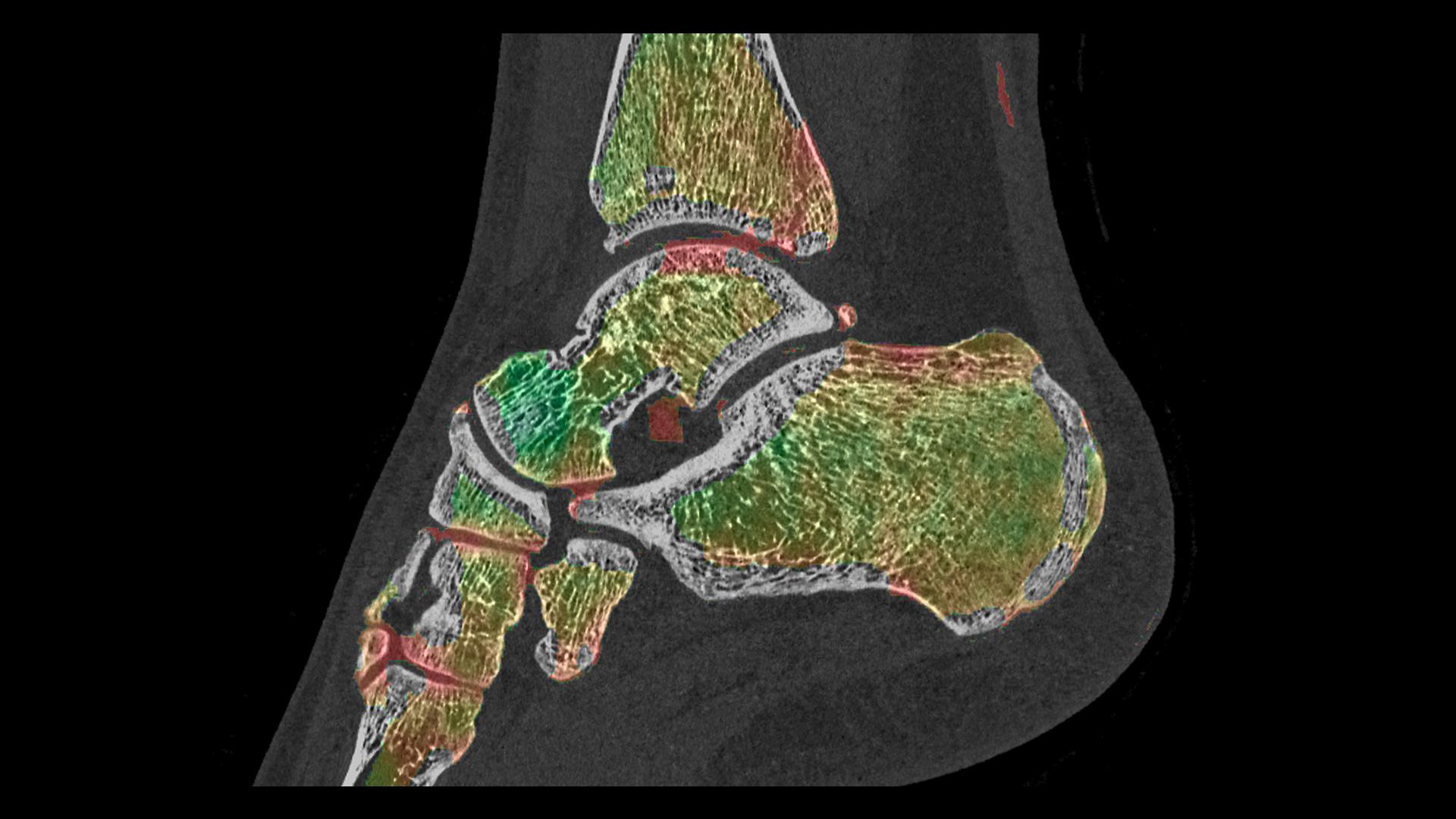 Photon-counting CT musculoskeletal imaging - Siemens Healthineers