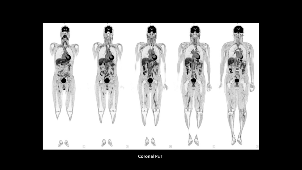 Biograph Vision Quadra News & Stories - Siemens Healthineers