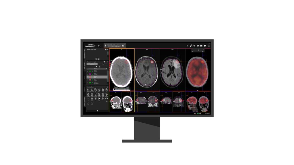 Autocontouring in radiation therapy - Siemens Healthineers - Siemens ...