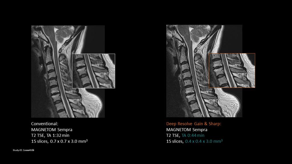 Deep Resolve - Siemens Healthineers